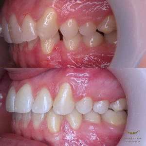 Zahnspangen Vorher-Nachher Bilder: Echte Fotos von Patienten