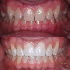 Zahnspangen Vorher-Nachher Bilder: Echte Fotos von Patienten